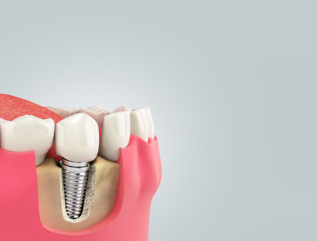 Single-Tooth Dental Implants in Salt Lake City UT
